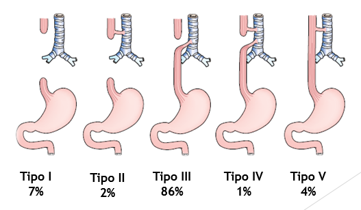 Trattamento chirurgico dell’atresia esofagea. Esperienza maturata in 10 ...